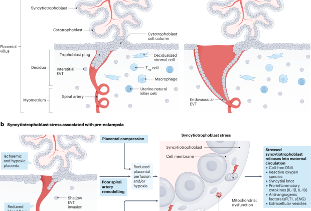 Understanding Preeclampsia: Causes, Symptoms, and Management ...