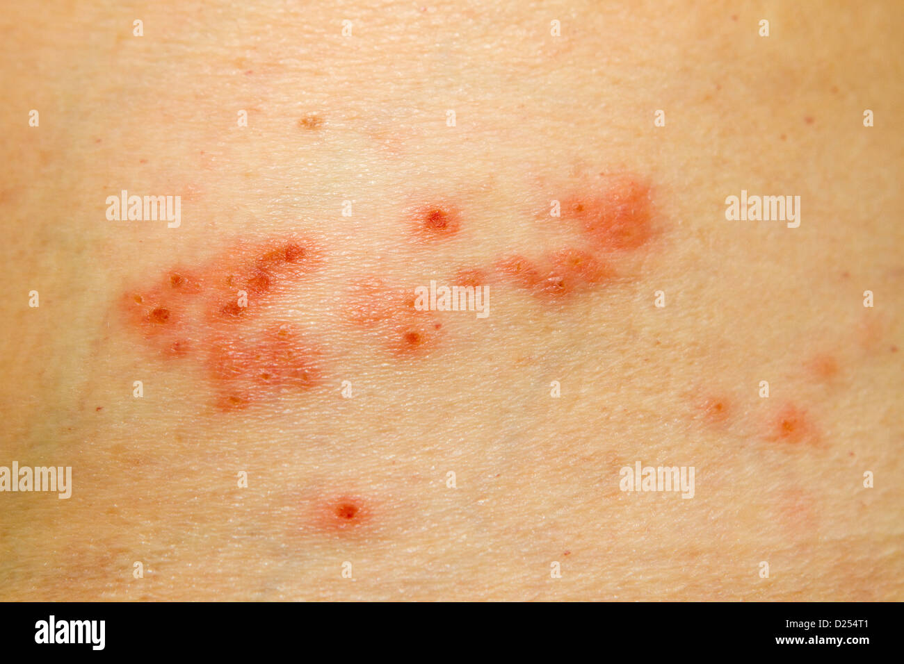 Understanding Shingles: Causes, Symptoms, and Treatment – Invisiverse News