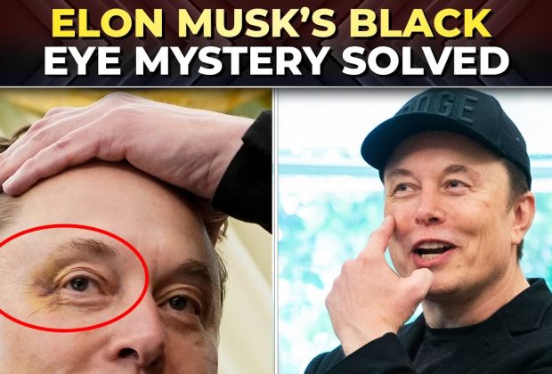 The Curious Case of Elon Musk’s Black Eye – Invisiverse News