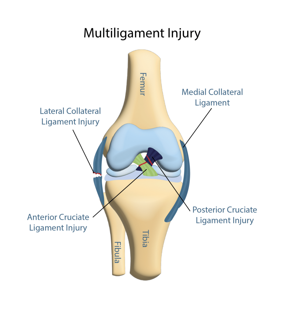 Understanding MCL Injury: Causes, Symptoms, and Treatments ...